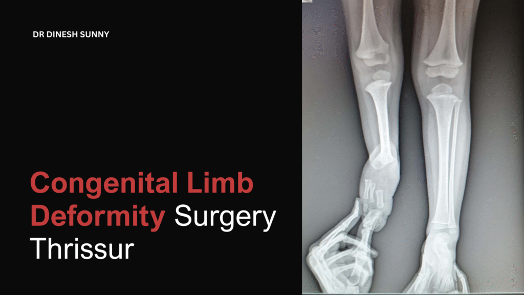 Congenital Limb Deformity surgery Thrissur - Dr. Dinesh Sunny Veliath